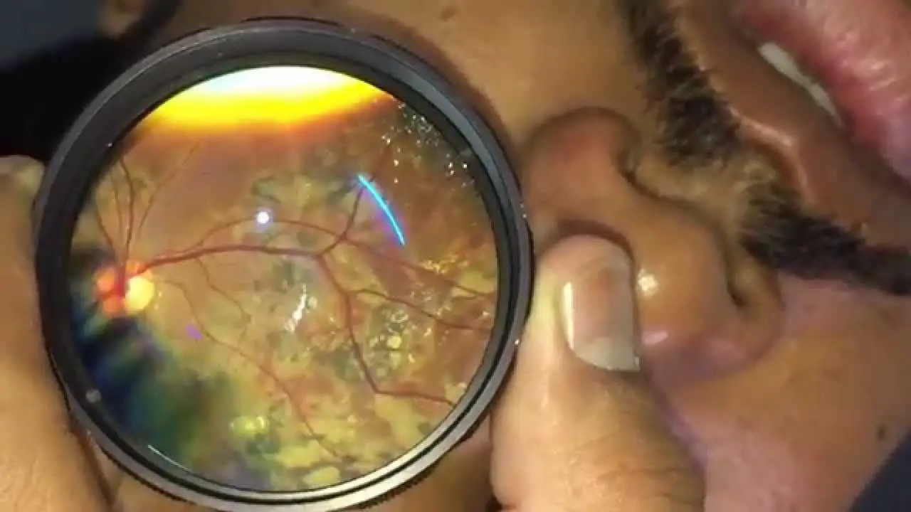 OFTALMOSCOPIO, ÚTIL PARA VER DE FORMA DIRECTA LA RETINA